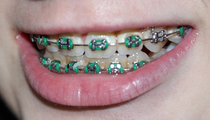 Five Common Questions About Braces | The Healthy Mouth Project Five Common Questions About Braces | The Healthy Mouth Project